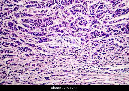 Lymph node cancer, light micrograph, photo under microscope Stock Photo ...