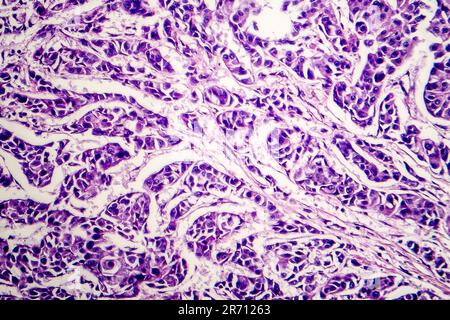 Lymph node cancer, light micrograph, photo under microscope Stock Photo ...