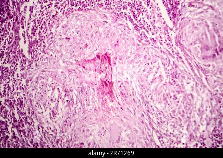 Histopathology of lymph nodal tuberculosis, light micrograph ...