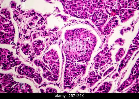 Lymph node cancer, light micrograph, photo under microscope Stock Photo ...