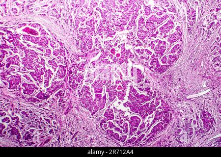 Lymph node cancer, light micrograph, photo under microscope Stock Photo ...