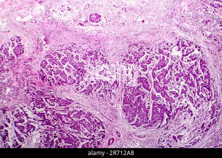 Lymph node metastasis, light micrograph of cancer that has spread to a ...