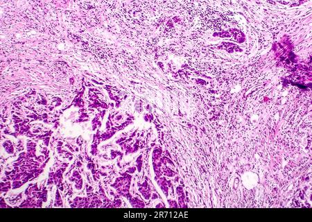 Lymph node cancer, light micrograph, photo under microscope Stock Photo ...