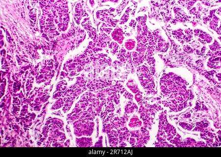 Lymph node cancer, light micrograph, photo under microscope Stock Photo ...