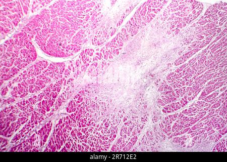 Acute myocardial infarction, histology of heart tissue, light ...
