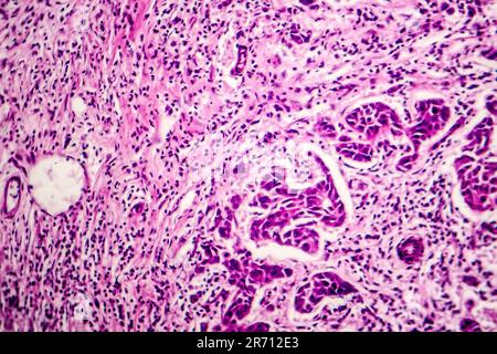 Lymph node cancer, light micrograph, photo under microscope Stock Photo ...