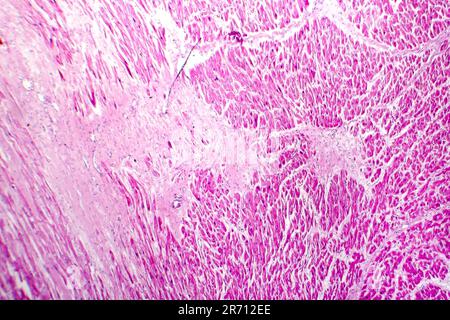 Acute myocardial infarction, histology of heart tissue, light ...