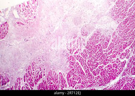 Acute myocardial infarction, histology of heart tissue, light ...
