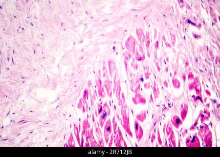 Acute myocardial infarction, histology of heart tissue, light ...