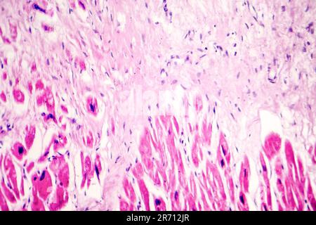 Acute myocardial infarction, histology of heart tissue, light ...