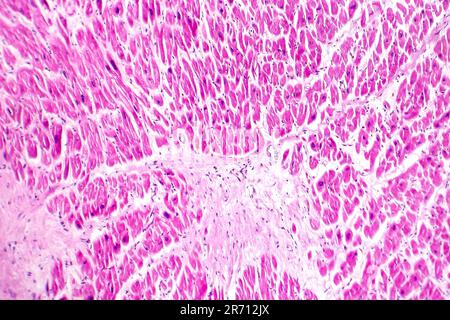 Acute myocardial infarction, histology of heart tissue, light ...