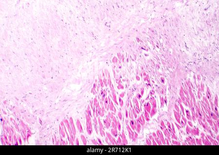 Acute myocardial infarction, histology of heart tissue, light ...
