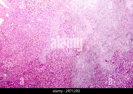 Histopathology of liver abscess, light micrograph, hematoxylin and eosin staining Stock Photo ...