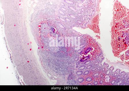 Histopathology of chronic appendicitis, light micrograph, photo under ...