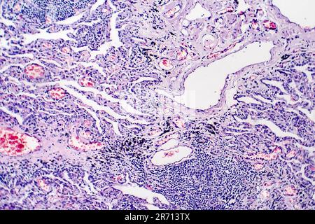 Histopathology of tuberculosis, light micrograph of tuberculosis lesion ...