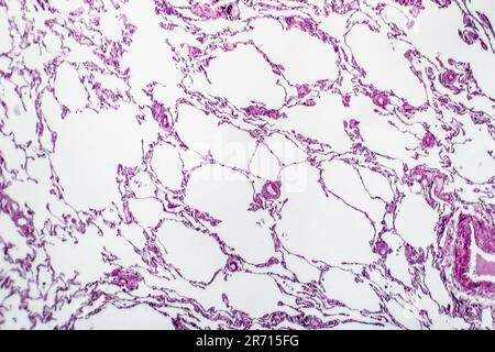 Histopathology of lung emphysema, light micrograph, photo under ...