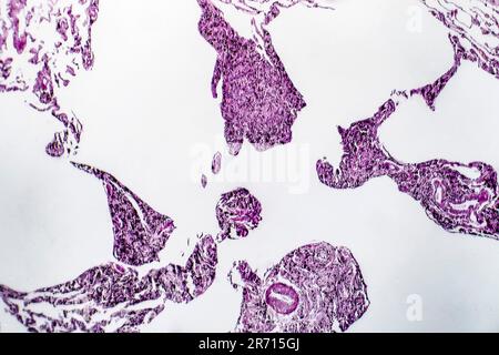 Histopathology of lung emphysema, light micrograph, photo under ...