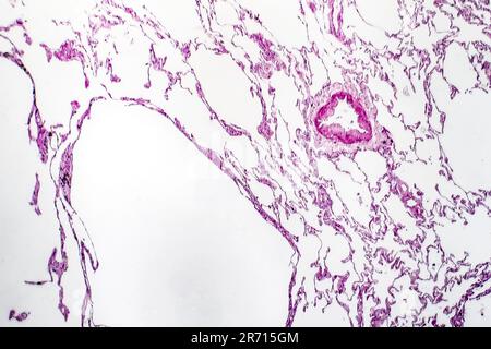 Histopathology of lung emphysema, light micrograph, photo under ...
