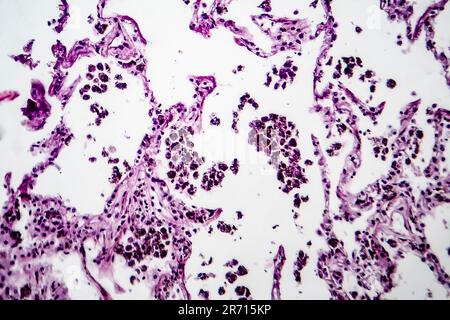 Histopathology of lung emphysema, light micrograph, photo under ...