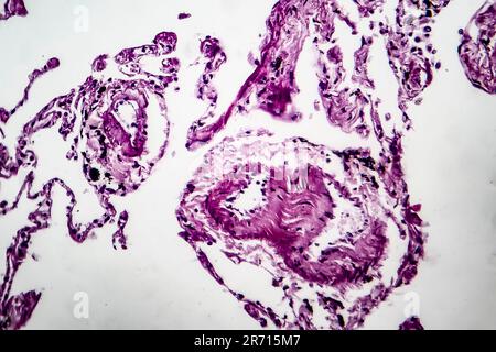 Histopathology of lung emphysema, light micrograph, photo under ...