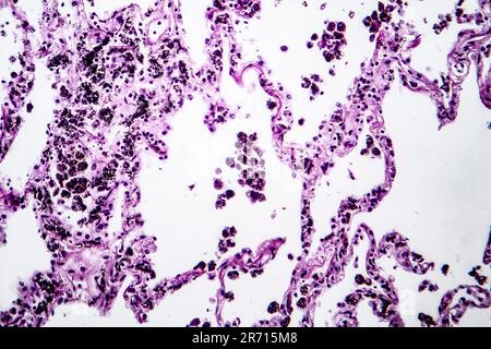 Histopathology of lung emphysema, light micrograph, photo under ...