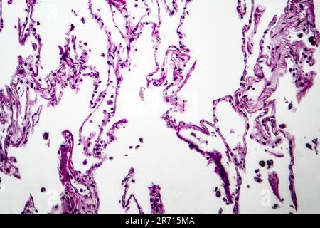 Histopathology of lung emphysema, light micrograph, photo under ...