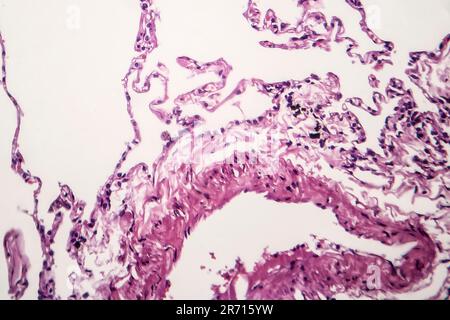 Histopathology of lung emphysema, light micrograph, photo under ...
