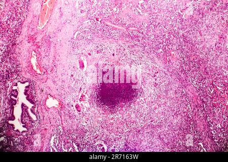 Histopathology of tubercle, light micrograph, photo under microscope ...
