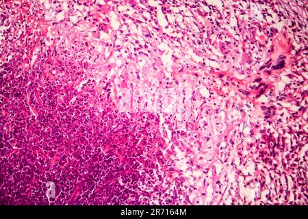 Histopathology of tubercle, light micrograph, photo under microscope ...