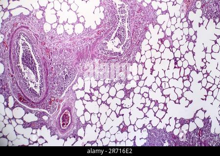 Histopathology of pneumonia, light micrograph, photo under microscope ...