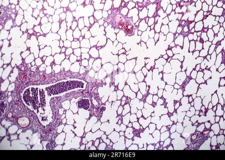 Histopathology of pneumonia, light micrograph, photo under microscope ...