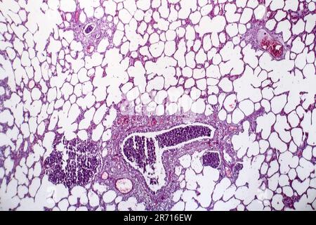 Histopathology of pneumonia, light micrograph, photo under microscope ...