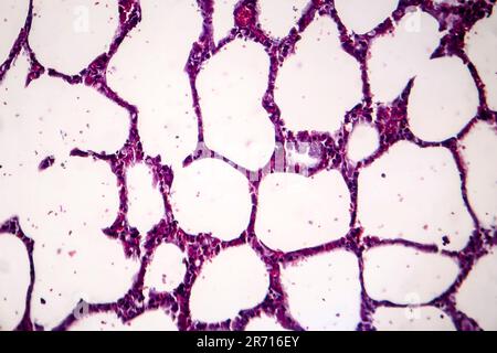 Histopathology of pneumonia, light micrograph, photo under microscope ...