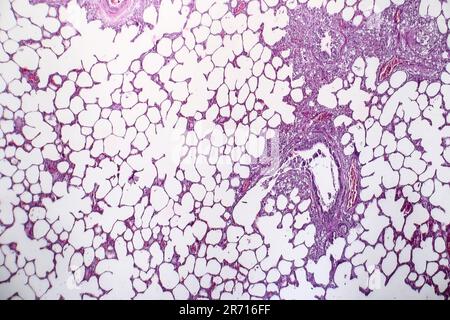 Histopathology of pneumonia, light micrograph, photo under microscope ...