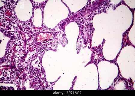 Histopathology of pneumonia, light micrograph, photo under microscope ...