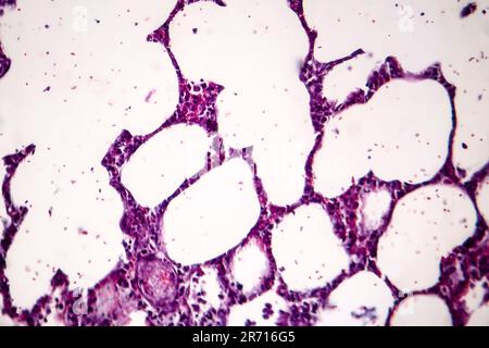 Histopathology of pneumonia, light micrograph, photo under microscope ...