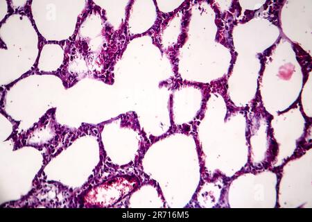 Histopathology of pneumonia, light micrograph, photo under microscope ...