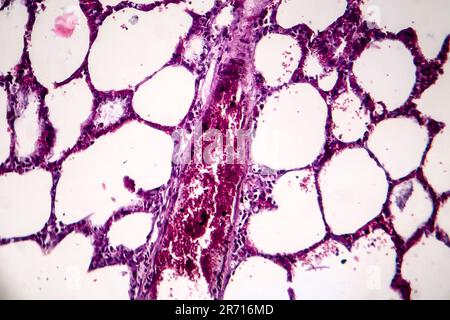 Histopathology of pneumonia, light micrograph, photo under microscope ...