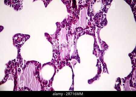 Histopathology of pneumonia, light micrograph, photo under microscope ...