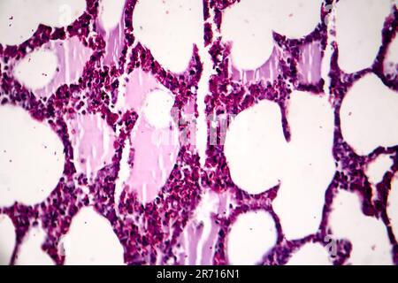 Histopathology of pneumonia, light micrograph, photo under microscope ...