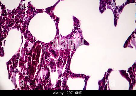 Histopathology of pneumonia, light micrograph, photo under microscope ...