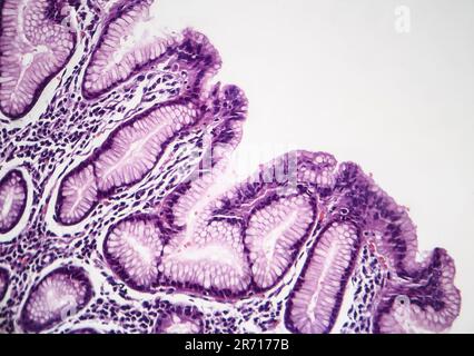 Histopathology of chronic superficial gastritis, light micrograph ...
