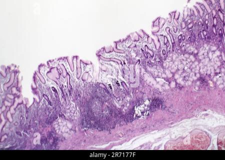 Histopathology of chronic superficial gastritis, light micrograph ...