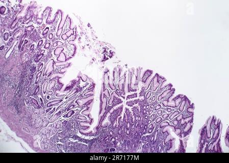 Histopathology of chronic superficial gastritis, light micrograph ...