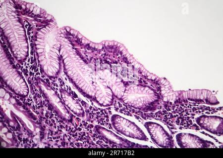 Histopathology of chronic superficial gastritis, light micrograph ...