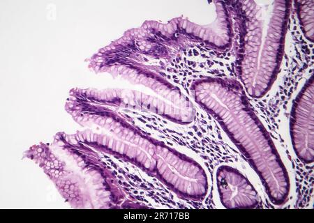 Histopathology of chronic superficial gastritis, light micrograph ...