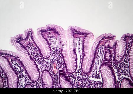 Histopathology of chronic superficial gastritis, light micrograph ...