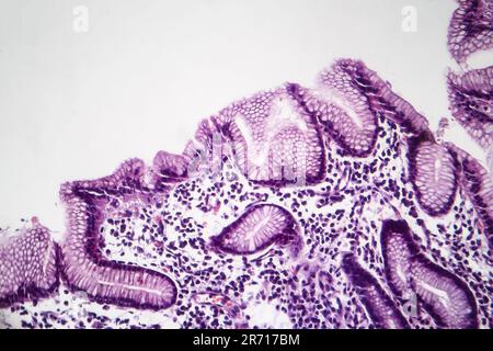 Histopathology of chronic superficial gastritis, light micrograph ...