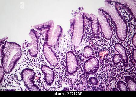 Histopathology of chronic superficial gastritis, light micrograph ...