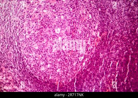 Acute simple appendicitis, light micrograph, photo under microscope ...